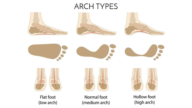 Arch Differences and Associated Problems | East Coast Podiatry Singapore