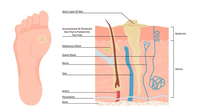 Foot Callus Causes, Symptoms & Removal | East Coast Podiatry