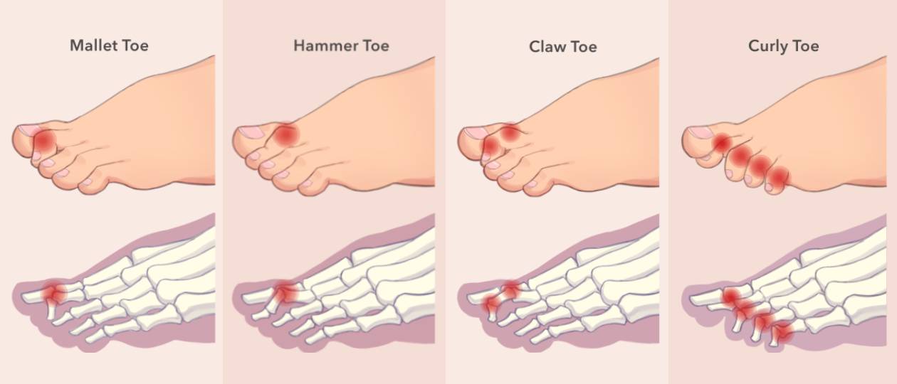 Curly Toe Syndrome | East Coast Podiatry Singapore