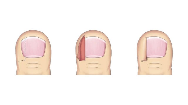 Ingrown Toenail Management | East Coast Podiatry Singapore