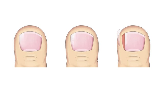Ingrown Toenail Management | East Coast Podiatry Singapore