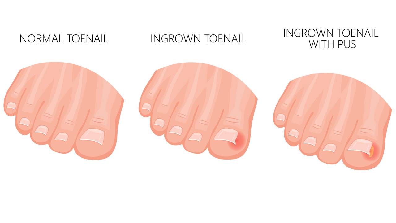 Ingrown Toenail Causes, Symptoms, and Pain Management | Singapore